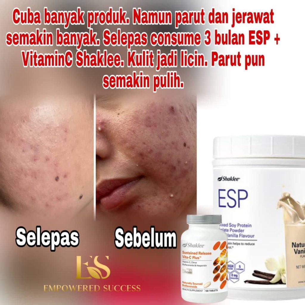 Parut Susah Hilang ? ESP & Vit C Shaklee Bantu Parut Hilang, Kulit ...