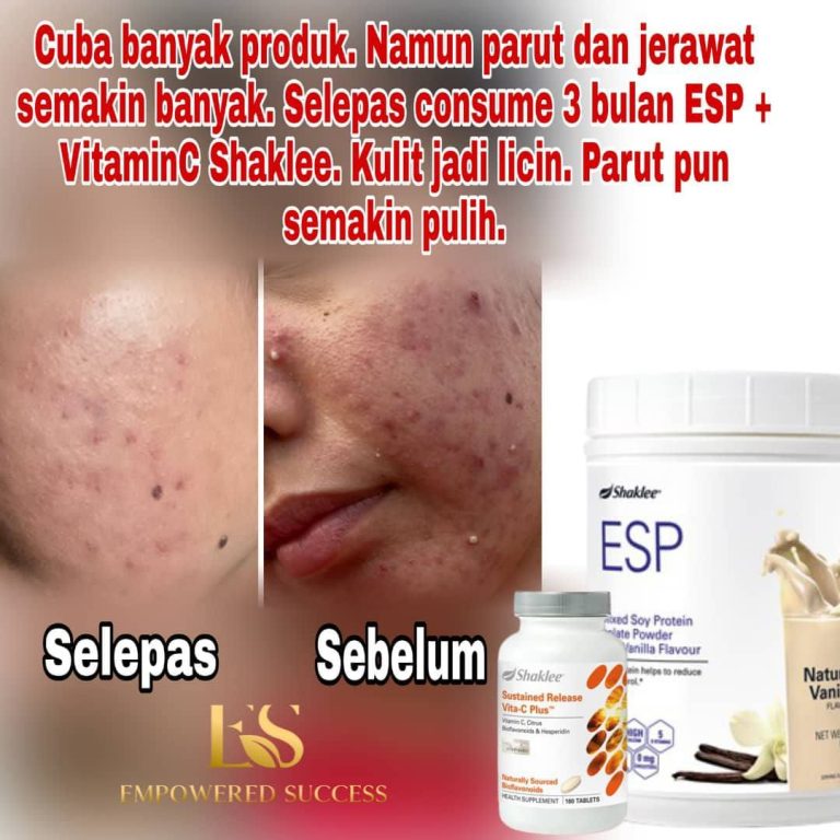 Parut Susah Hilang ? ESP & Vit C Shaklee Bantu Parut Hilang, Kulit ...