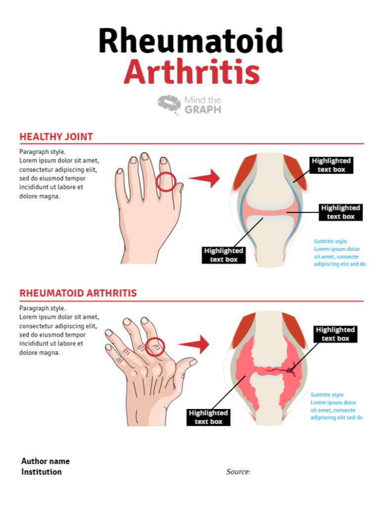 Hilangkan Sakit Rheumatoid Arthritis